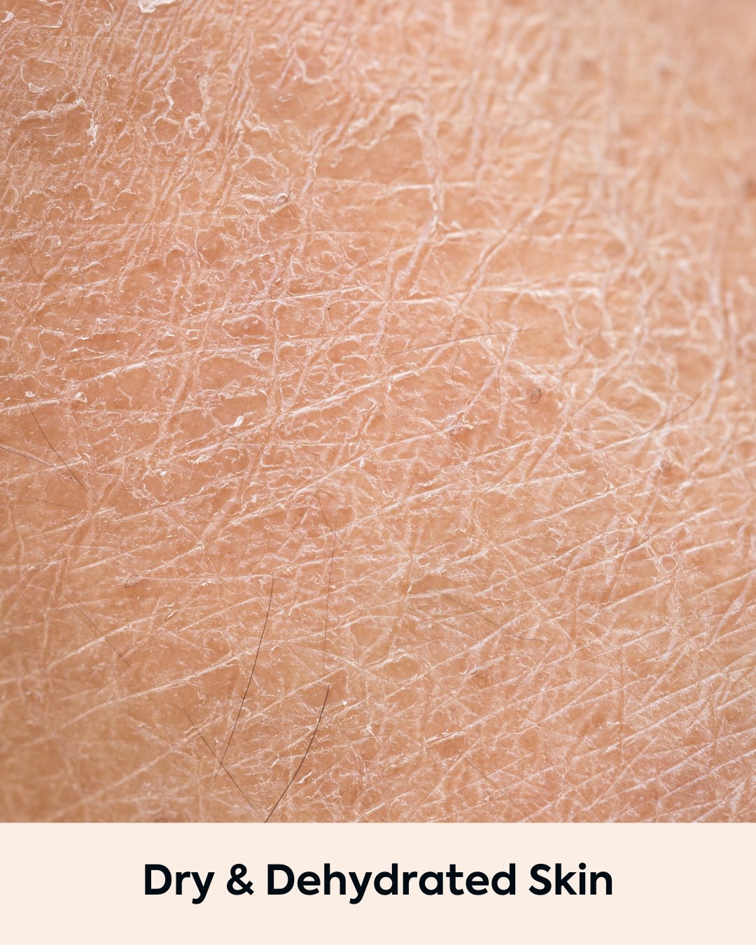 Dry & Dehydrated Skin - Momora